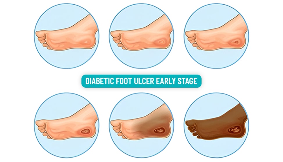 Diabetic Foot Symptoms: From Early Warning Signs - Divyam